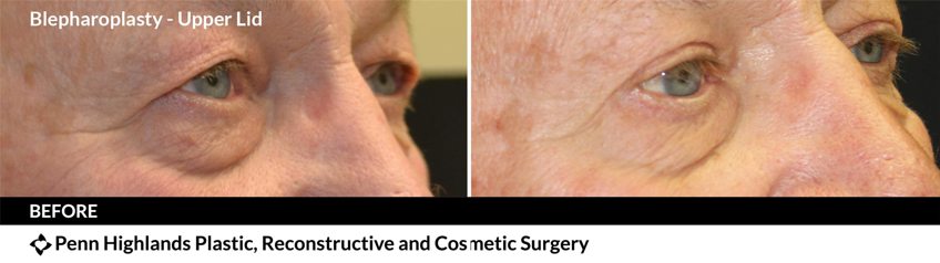 Eyelid Surgery (Blepharoplasty) Before & After Gallery | Penn Highlands ...